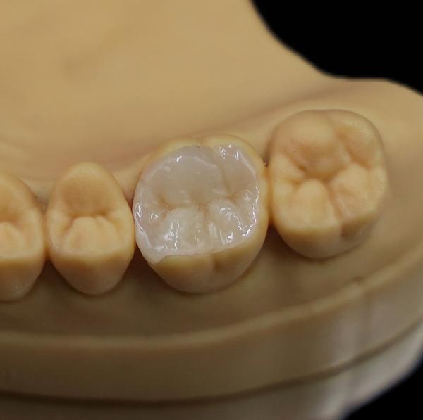 Quality Lithium Disilicate Inlay Emax Digital Dental Design Services for sale
