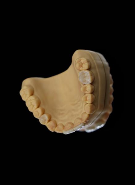 Quality CE Heat Pressed Lithium Disilicate Emax Inlay For Dental Restorations for sale