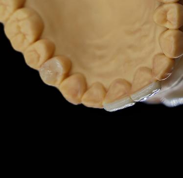 Quality IPS Emax Inlay Lithium Disilicate Dental Inlay China Dental Lab for sale
