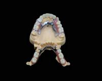 China Cobalt Chromium Alloy Dental Framework Precision Digital Workflow 3D Printing for sale