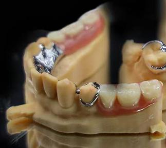 Quality Cobalt Chromium Alloy CCP Framework Dental Lab Polished Surface for sale