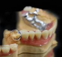 Quality Biocompatible 3D Printed Cast Metal Framework With Resin Denture Bases for sale
