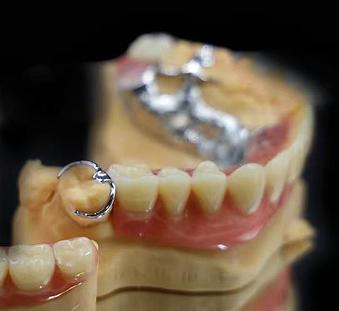 Quality Biocompatible 3D Printed Cast Metal Framework With Resin Denture Bases for sale