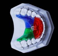 China Pre-Prosthetic Maxillary Expander Hyrax Tooth Borne 0.20-0.25 mm Expansion for sale