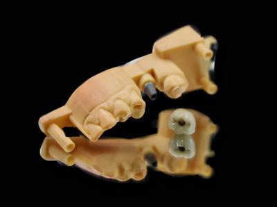 China Corrosion Resistant Artificial Tooth Root Suitable for Multiple Dental Applications Providing Secure Implant Fixation for sale