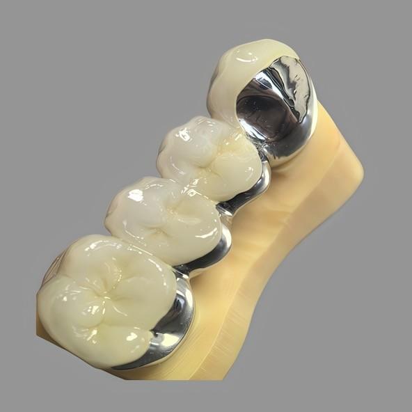 Quality Casting / Digital CoCr Dental PFM Bridge with Polished Surface for sale