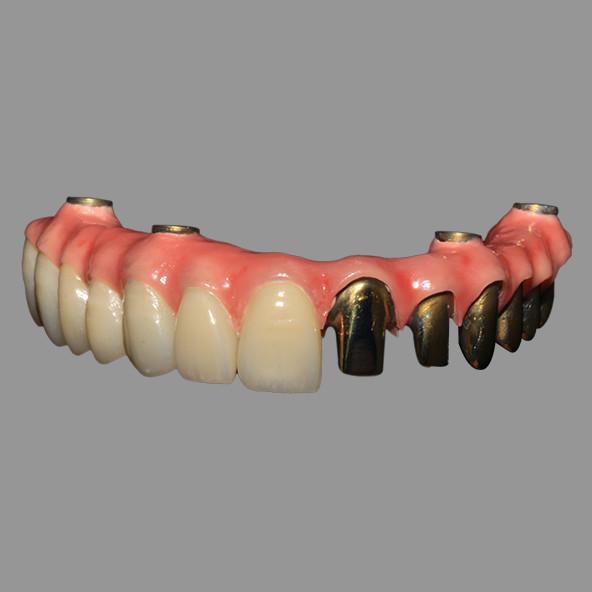 Quality Class 2 Hybrid Malong Full Arch AOX Implant Bridge Titanium Bar with Full Solid for sale