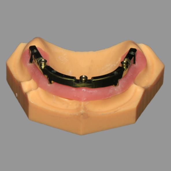 Quality Full Acrylic Denture All On X Dental Implants AOX Class 4 With Locator for sale