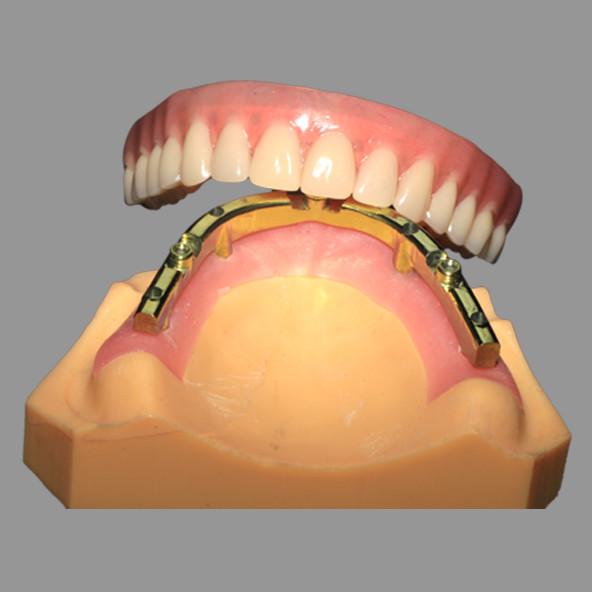 Quality Full Acrylic Denture All On X Dental Implants AOX Class 4 With Locator for sale
