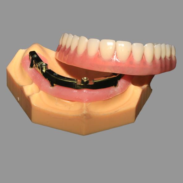 Quality Full Acrylic Denture All On X Dental Implants AOX Class 4 With Locator for sale