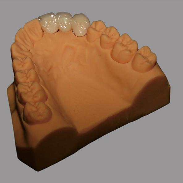Quality Biocompatible Full Ceramic PFZ Bridge With CAD / CAM System for sale