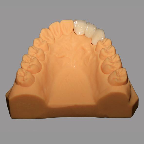 Quality Biocompatible Full Ceramic PFZ Bridge With CAD / CAM System for sale