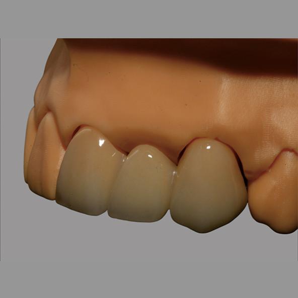 Quality Biocompatible Full Ceramic PFZ Bridge With CAD / CAM System for sale