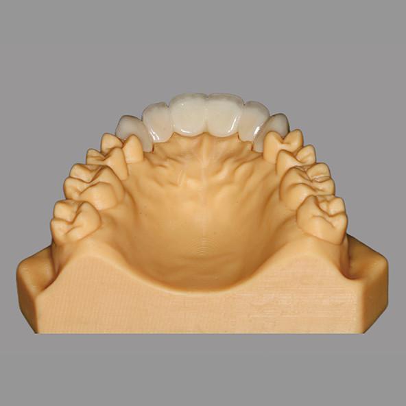 Quality Aesthetic Porcelain Fused To Zirconia Bridge Hypoallergenic for sale