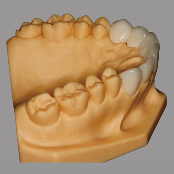 Quality Aesthetic Porcelain Fused To Zirconia Bridge Hypoallergenic for sale