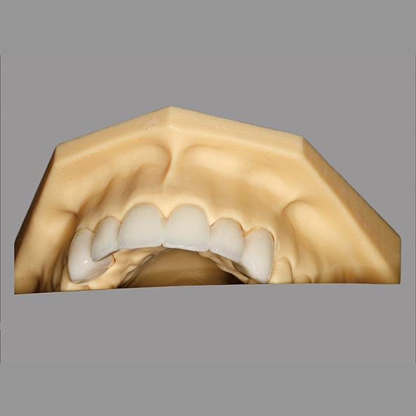 Quality Aesthetic Porcelain Fused To Zirconia Bridge Hypoallergenic for sale