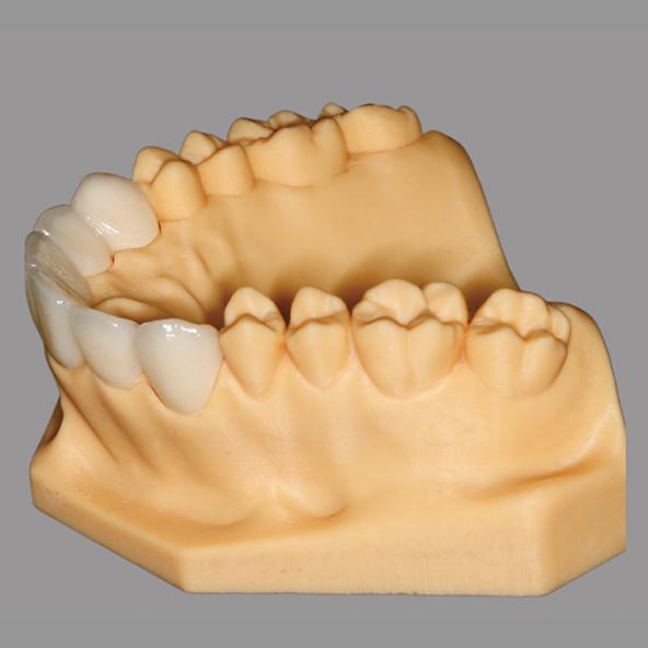 Quality Aesthetic Porcelain Fused To Zirconia Bridge Hypoallergenic for sale