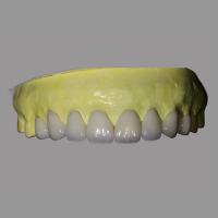 Quality High Translucency IPS E Max Veneers Stains Resistant Biocompatible for sale