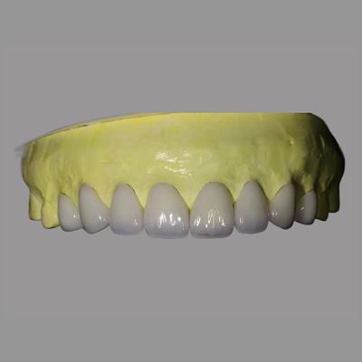 China High Translucency IPS E Max Veneers Stains Resistant Biocompatible for sale