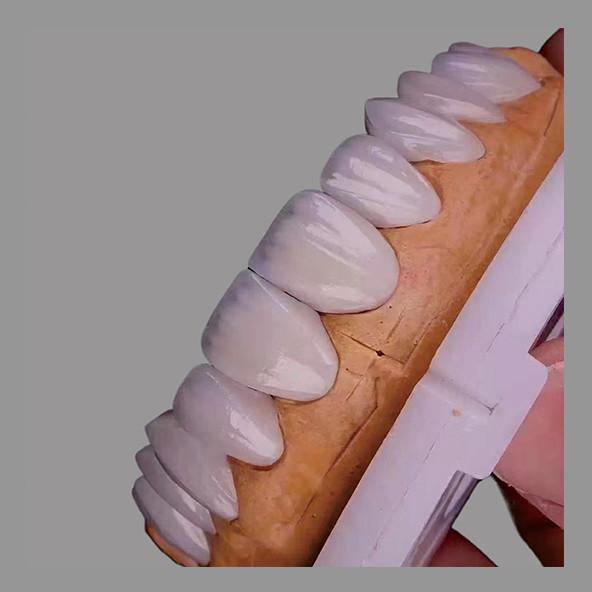Quality High Translucency IPS E Max Veneers Stains Resistant Biocompatible for sale