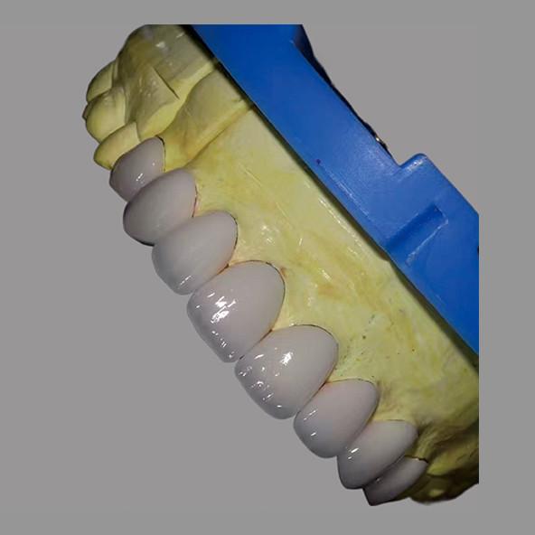 Quality High Translucency IPS E Max Veneers Stains Resistant Biocompatible for sale