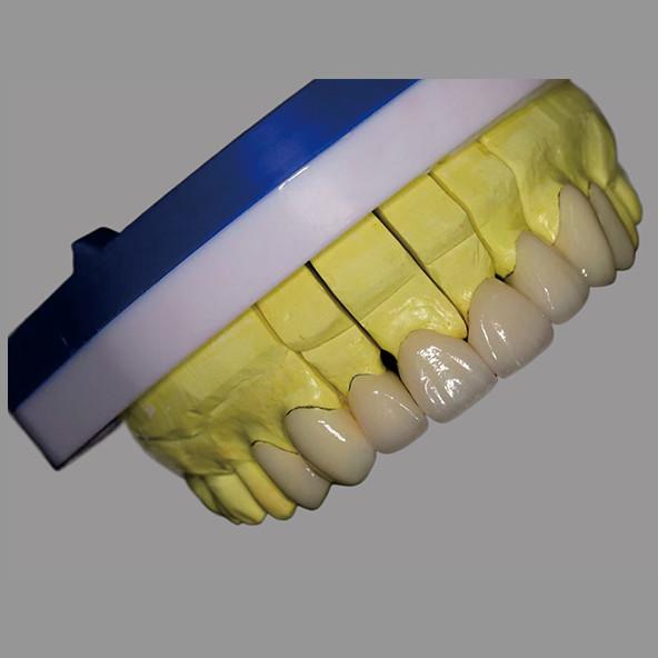 Quality High Translucency IPS E Max Veneers Stains Resistant Biocompatible for sale