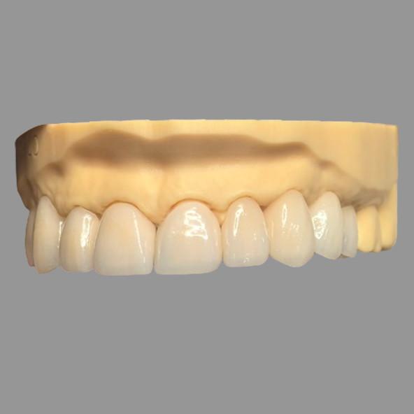 Quality Smooth Pressed IPS EMax Crowns Staining Resistant Customizable for sale
