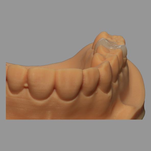 Quality Emax Dental Lab | Full Ceramic Dental Emax Inlay Onlay Crown Pressed / Milled for sale
