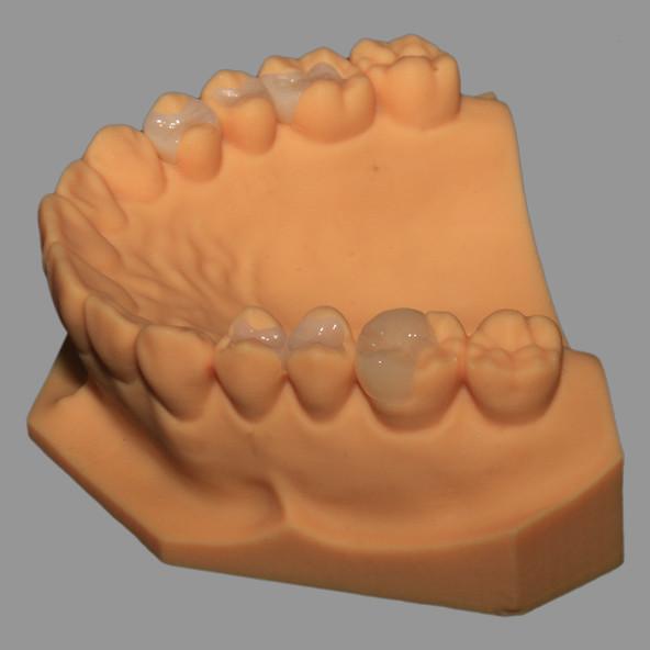Quality Emax Dental Lab | Full Ceramic Dental Emax Inlay Onlay Crown Pressed / Milled for sale