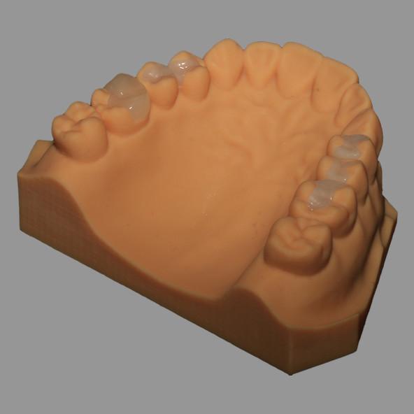Quality Emax Dental Lab | Full Ceramic Dental Emax Inlay Onlay Crown Pressed / Milled for sale