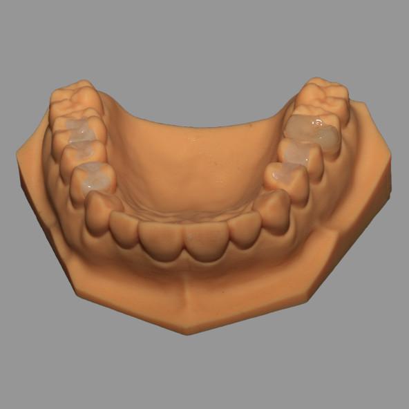 Quality Emax Dental Lab | Full Ceramic Dental Emax Inlay Onlay Crown Pressed / Milled for sale