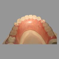 China Dental Lab Crown |  Casting Pink TCS Flexible Partials With Excellent Retention for sale