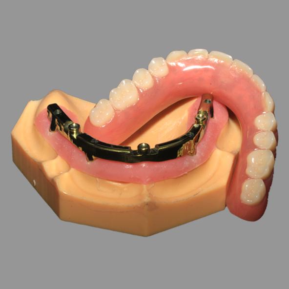 Quality Full Acrylic Denture All On X Dental Implants AOX Class 4 With Locator for sale