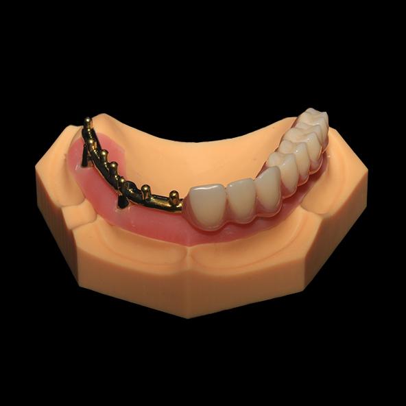Quality Class 3 Milled Titanium Bar All On X Dental Implants with Full Acrylic Denture for sale