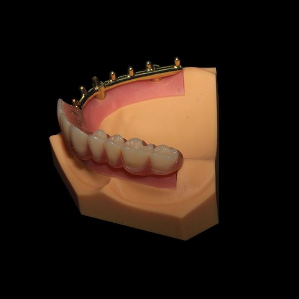 Quality Class 3 Milled Titanium Bar All On X Dental Implants with Full Acrylic Denture for sale
