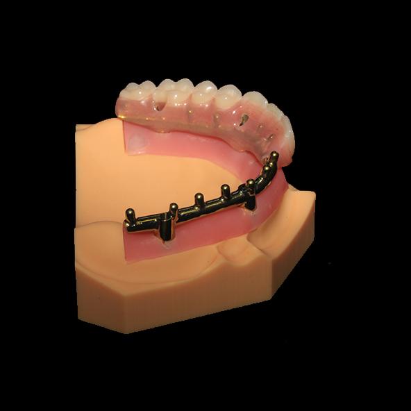 Quality Class 3 Milled Titanium Bar All On X Dental Implants with Full Acrylic Denture for sale