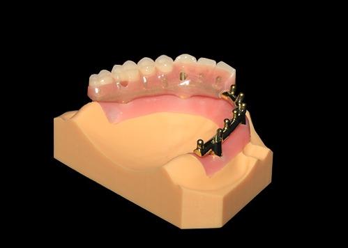 Quality Class 3 Milled Titanium Bar All On X Dental Implants with Full Acrylic Denture for sale