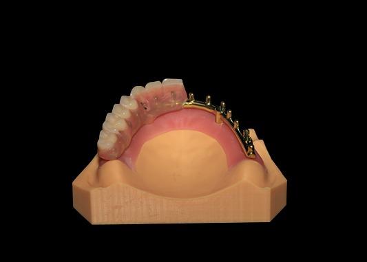 Quality Class 3 Milled Titanium Bar All On X Dental Implants with Full Acrylic Denture for sale