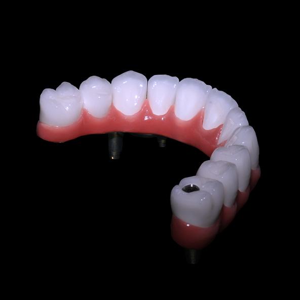 Quality Dental PFM Crown And Bridge Customizable With CoCr Ceramic Materials for sale