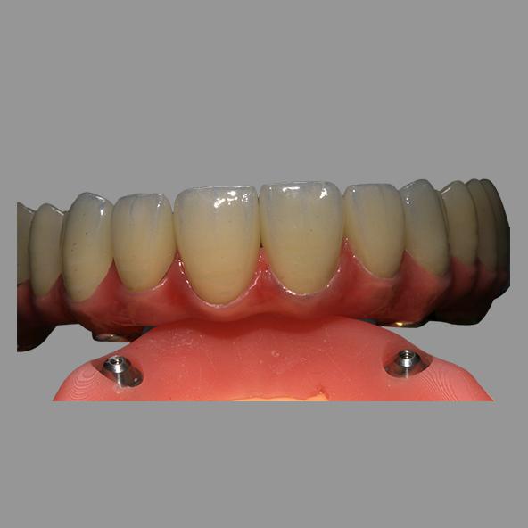 Quality Class 2 Hybrid Malong Full Arch AOX Implant Bridge Titanium Bar with Full Solid for sale