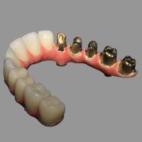 Quality Class 2 Hybrid Malong Full Arch AOX Implant Bridge Titanium Bar with Full Solid for sale