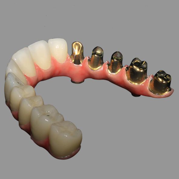Quality Class 2 Hybrid Malong Full Arch AOX Implant Bridge Titanium Bar with Full Solid for sale