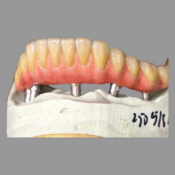 Quality Class I AOX Implants All On 4 Hybrid Titanium Screw Retained Full Zirconia for sale