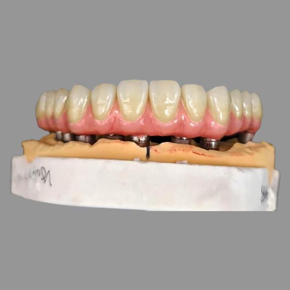 Quality Class I AOX Implants All On 4 Hybrid Titanium Screw Retained Full Zirconia for sale