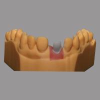 Quality White Custom Zirconia Abutment Natural Looking For Dental Restoration for sale