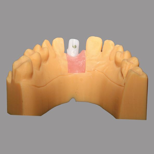 Quality White Custom Zirconia Abutment Natural Looking For Dental Restoration for sale