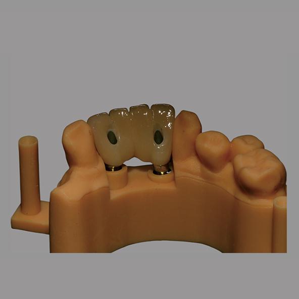 Quality Gold Plating Nitrogen Titanium Abutments Dental Implants Cad/Cam Compatibility for sale