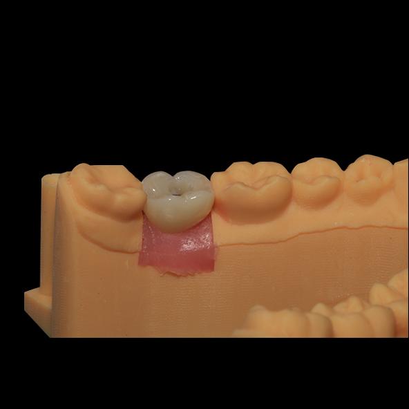 Quality Silver Custom Titanium Abutments Dental Implants With Full Zirconia Crown for sale