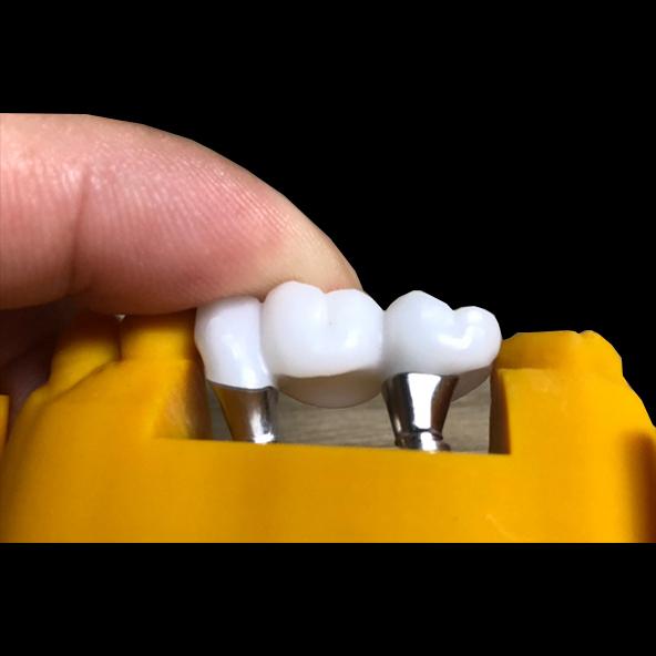 Quality Silver Custom Titanium Abutments Dental Implants With Full Zirconia Crown for sale