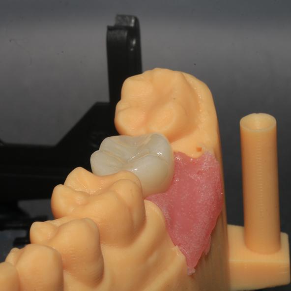 Quality Silver Custom Titanium Abutments Dental Implants With Full Zirconia Crown for sale